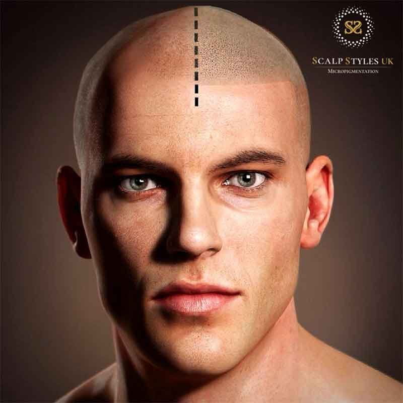 Benefits of Scalp Micropigmentation (SMP) | Scalp Styles UK