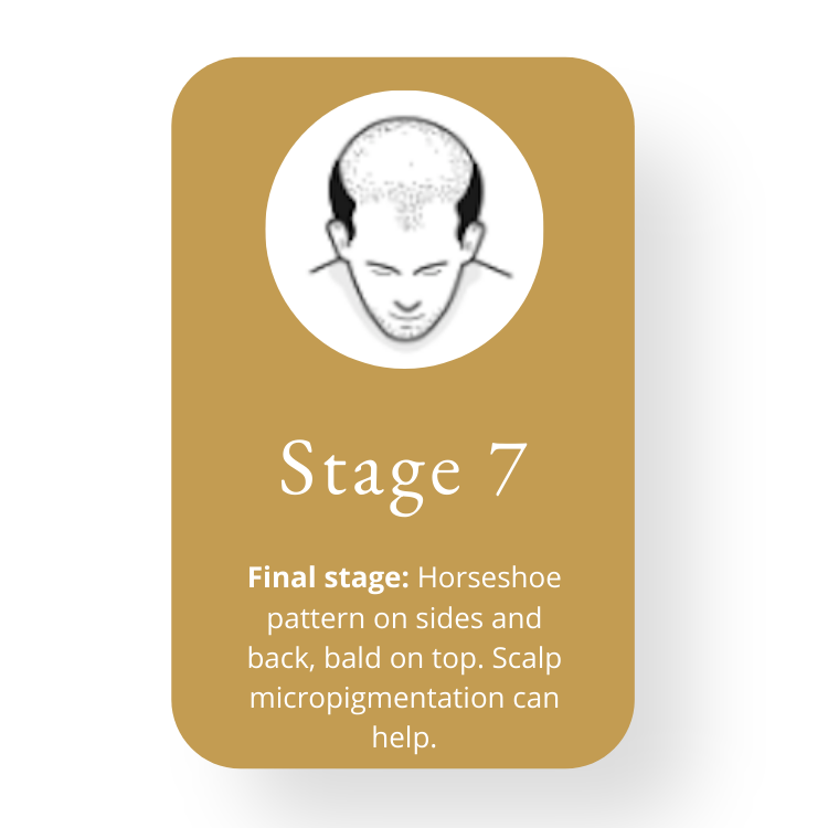Male Pattern Baldness - The 7 Stages | Scalp Styles UK